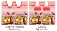 China Sublative RF Machine Innovative Skin Resurfacing And Facial Countour Technology For All Skin Types for sale