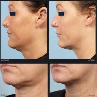 China Microneedling RF Fractional Radio Frequency Beauty Equipment Facelift Skin Tight for sale