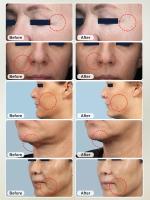 China Rf Fractional Microneedle Rf Face Lifting Anti Wrinkle Machine for sale