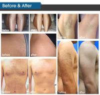 China High Power Portable 755 808 1064nm 808 Nm Diode Laser Hair Removal Machine for sale