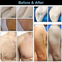 China High Power Painless 755 808 1064nm Diode Laser Hair Removal Device for sale