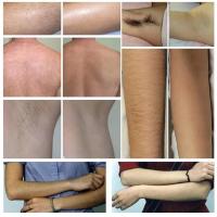 China High Power Painless 755 808 1064nm Diode Laser Hair Removal Device for sale