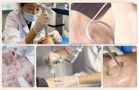 China Surgical Fractional Co2 Laser Yag Laser Carbon Acne Scar Removal Wrinkle Reduction Machine for sale