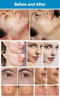 China Fractional Co2 Laser Price Acne Scar Removal Product Stainless Brass Carbon Steel Laser Cutting Machine for sale