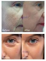 China Portable 5Mhz Fractional RF Device for Face Lift and Skin Tightening for sale