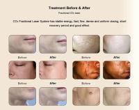 China Vaginal Tightening Q Switched Nd Yag Carbon Fractional Co2 Laser Vaginal Tightening Machine for sale