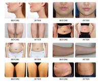 China Newangie New Arrival Cryo 360 Cryolipolysis Fat Removal Cryo Therapy Fat Cryolipolysis Slimming Machine for sale