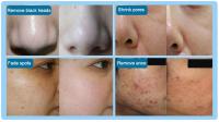 China 4 Tips Dermabrasion Diamond Peel Hydro Facial Machines for sale
