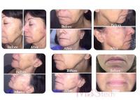 China 3d 11 Lines Anti Wrinkle Ultrasound Facelift HIFU Facial Machine for sale