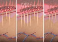 China 3.5 Mm Depth 5mhz Fractional Rf Microneedle Machine for sale