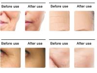 China RF HIFU Home Use Wrinkle Remover Machine Multifunctional Facial Beauty Vmax for sale