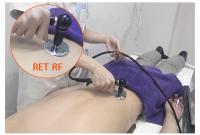 China CET RET Tecar Therapy Machine Skin Rejuvenation Sport Injury Recovery for sale