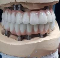 China Precision-Crafted Zirconia Implant Screw Cement Retained for Natural-Looking Teeth for sale