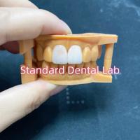 China High Colour Stability Ivoclar Emax Laminate Veneers High Translucency for sale