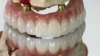 China Dental All On X Implant PFM Crown Titanium Fixed Hybrid Denture for sale