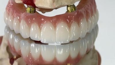 China Dental All On X Implant PFM Crown Titanium Fixed Hybrid Denture for sale
