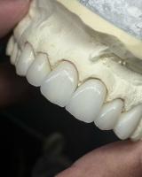 China Transluency Layered Zirconia Crown for Optimal Functionality and Natural Aesthetics for sale