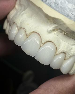 China Transluency Layered Zirconia Crown for Optimal Functionality and Natural Aesthetics for sale