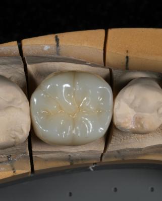 China Full Contour Zirconia Crown Quick Turnaround for Precise and Aesthetic Fit in 1 Week for sale