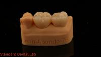 China Solid Dental Lab Crowns 3D Pro High Translucency Full Zirconia Crowns with 5-Year Guarantee for sale