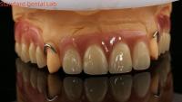 China Heat Cured Ivoclar Partial Acrylic Denture Dental Lab High Accuracy with 3D print model for sale