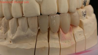 China Solid Dental Lab Crowns 3D Pro High Translucency Full Zirconia Crowns with Vita Shade Customized for sale