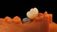 China High Aesthetic Full Contour Zirconia Crown with Metal Post Core 5 Years Guarantee and Better Technicians from SDL Dental Lab for sale
