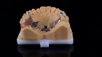 China Partial Cobalt Chrome Dentures Ivoclar Scheftner Comfortable Metal Framework Delivered in Just 3 Days for sale