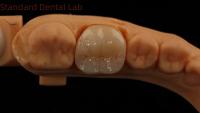 China Dental Digital Full Zirconia Crown with Noritake Porcelain 3D Print Model 5 Year Guarantee for sale