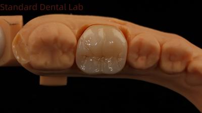 China Dental Digital Full Zirconia Crown with Noritake Porcelain 3D Print Model 5 Year Guarantee for sale