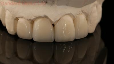 China Strong Layered Zirconia Crown And Bridge In Good Esthetics Zirconia Layered China Dental Lab for sale