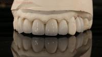 China China Dental Lab Zirconia Full Contour Crown High Aesthetic Natural Dental Bridge 5 Year Guarantee for sale