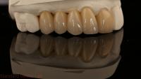 China Noritake Porcelian Full Contour Zirconia Crown High Aesthetic Natural Customized Zirconia Dental Bridge for sale