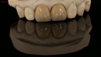 China Full Contour Zirconia Crown and High Aesthetic Natural Dental Bridge 5 Year Guarantee for sale