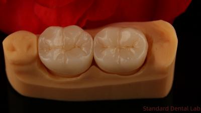 China Full Contour Zirconia Crown Exceptional Strength and Esthetics No Porcelian Overlay Posterior Crown China Dental Lab for sale