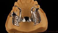 China Metal Alloys Partial Cobalt Chrome Dentures Ivoclar Scheftner Comfortable China Dental Lab for sale