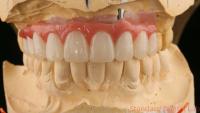 China Good Fitting Precise Esthetic Zirconia Porcelain Crown Pink Porcelian With Bleaching Shade for sale