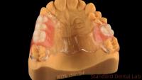China Flexible Clear Metal Cast Framework Partial Dentures High Esthetics Perfect Fit for sale