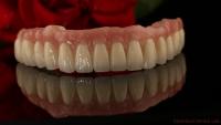 China Zirconia Titanium Dental Implants All On 4 Full Arch Teeth Replacement 3-6 Months Healing Time for sale