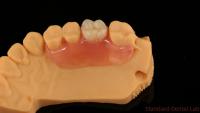 China Dental TCS Valplast Flexible Partial Dentures Nesbit Valplast Finish China Dental Lab Valplast Clasp for sale