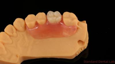 China Dental TCS Valplast Flexible Partial Dentures Nesbit Valplast Finish China Dental Lab Valplast Clasp for sale