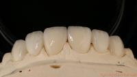 China Precise Zirconia Crown Bridge Comfortable Fit / Esthetics 3-4 Days Quick Turnaround Time for sale