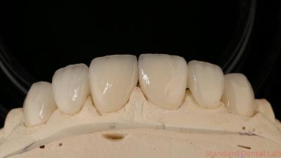 China Precise Zirconia Crown Bridge Comfortable Fit / Esthetics 3-4 Days Quick Turnaround Time for sale