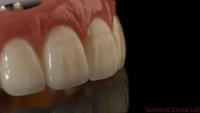 China Professional Zirconia Dental Implant Crown Titanium CAD CAM Zirconia Crown China Dental Lab for sale