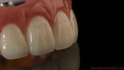 China Professional Zirconia Dental Implant Crown Titanium CAD CAM Zirconia Crown China Dental Lab for sale