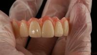 China Porcelain All On Four Zirconia Bridge High Esthetics Dental Implant Bridge for sale