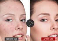 China Oil Control  Anti Aging Cream For Acne Prone Skin Therapeutic Grade Reduce Redness for sale