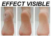 China Dry Cracked Hand And Foot Cream Products Callus Remover With Oem Odm Service for sale