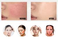China OEM After Sun Gel Soothe Hydrate Sunburn Pain Relief for sale