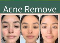 China Clears Prevents Acne Anti Blemish Face Cleanser Skin Care for sale
